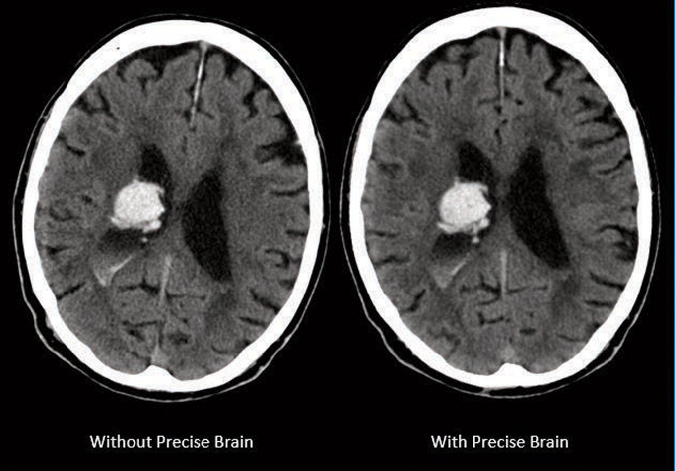 Philips | Precise Brain - RadMag - Online-Journal für die Radiologie ...